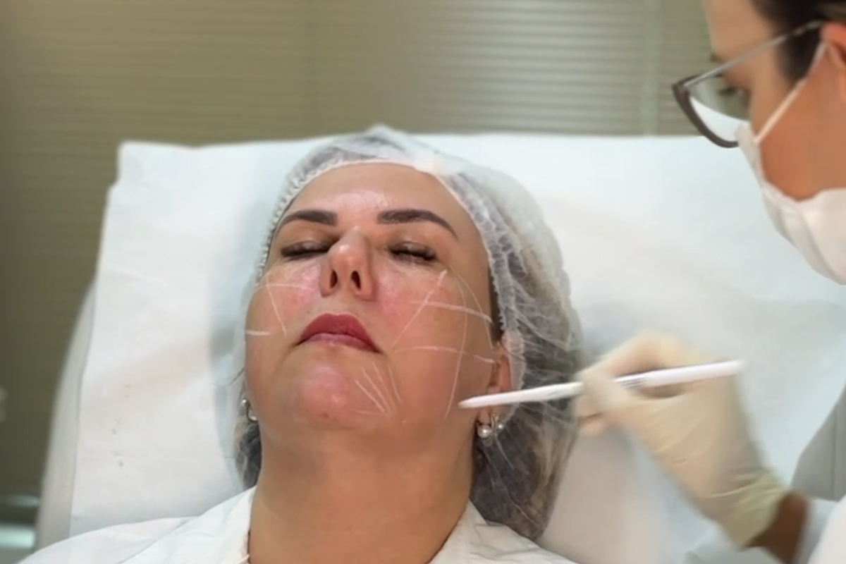 Botox e Microbotox: Entenda as Diferenças e os Benefícios para Quem Tem ...