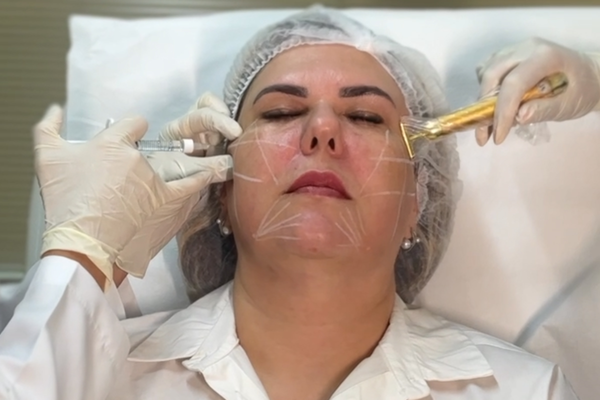 Botox e Microbotox: Entenda as Diferenças e os Benefícios para Quem Tem ...