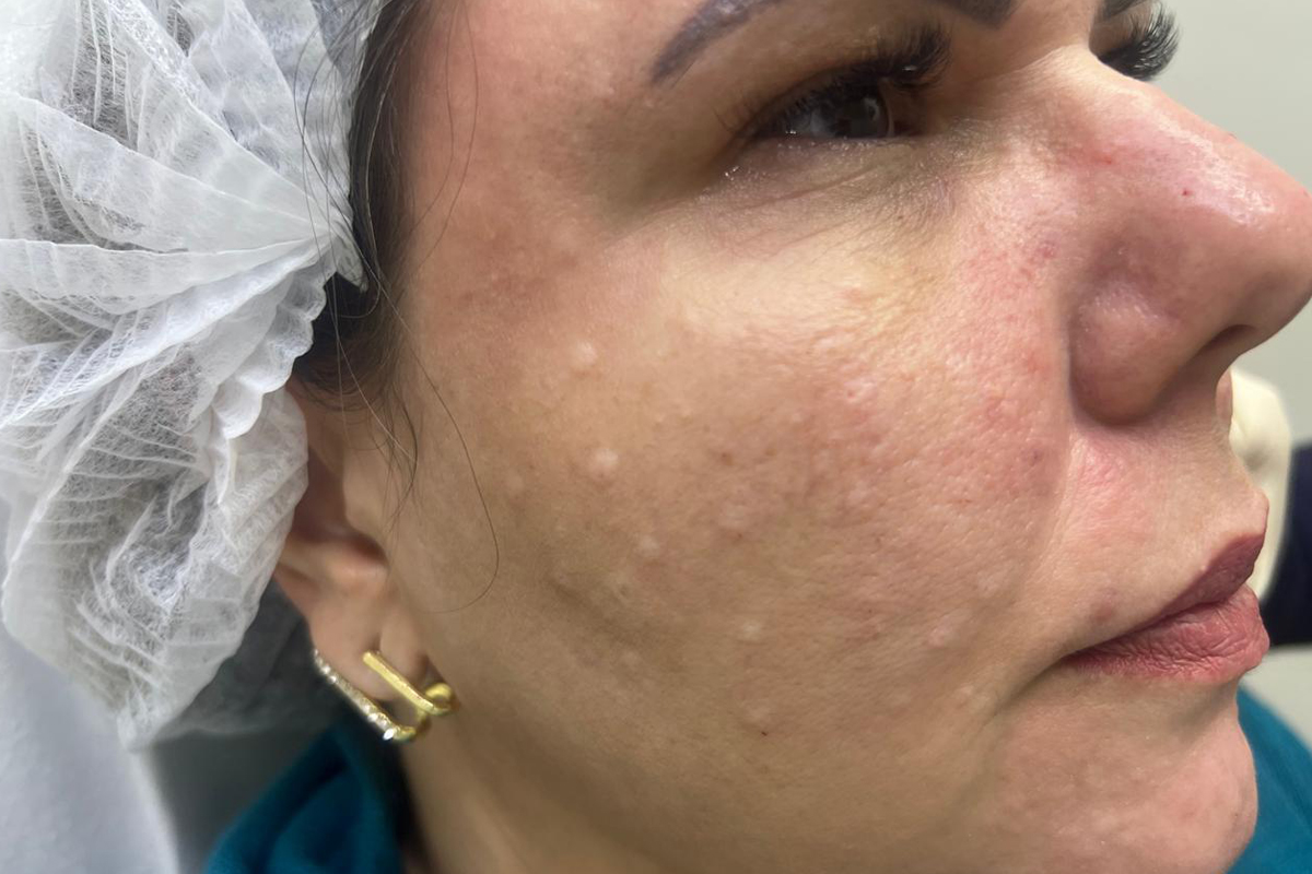 Botox e Microbotox: Entenda as Diferenças e os Benefícios para Quem Tem ...